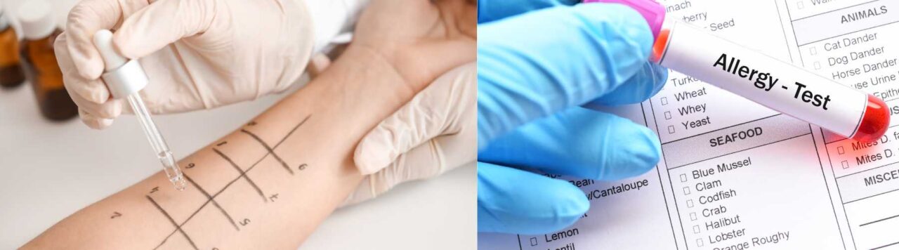 Allergy Testing Services | Copperfield Family Clinic